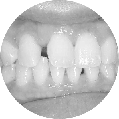 Orthodontic Treatments in Singapore | Braces & Teeth Alignment