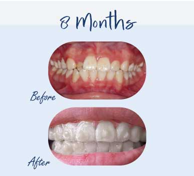 Invisible Braces | Redefining Smiles with Clear Aligners
