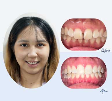 Invisible Braces | Redefining Smiles with Clear Aligners