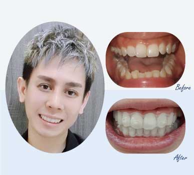 Invisible Braces | Redefining Smiles with Clear Aligners